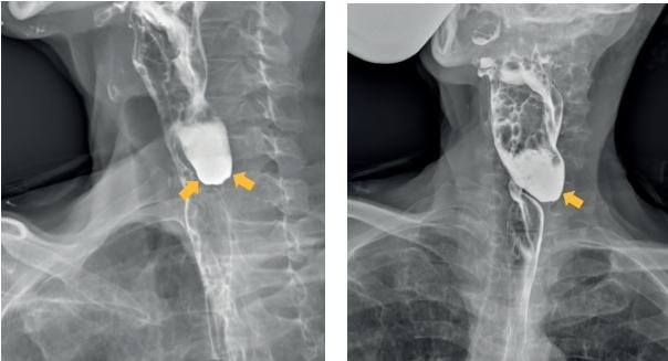 Estenose Esofagica Engolir Bario The Radiology Assistant : Esophagus