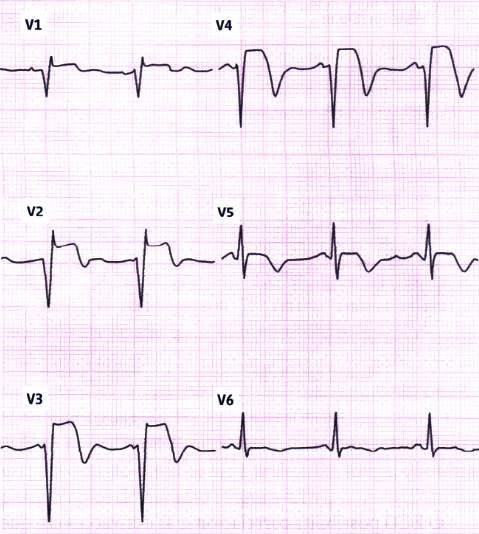 CONSIDERAÇÕES ELETROCARDIOGRAFICAS SOBRE A CARDIOPATIA ISQUÊMICA